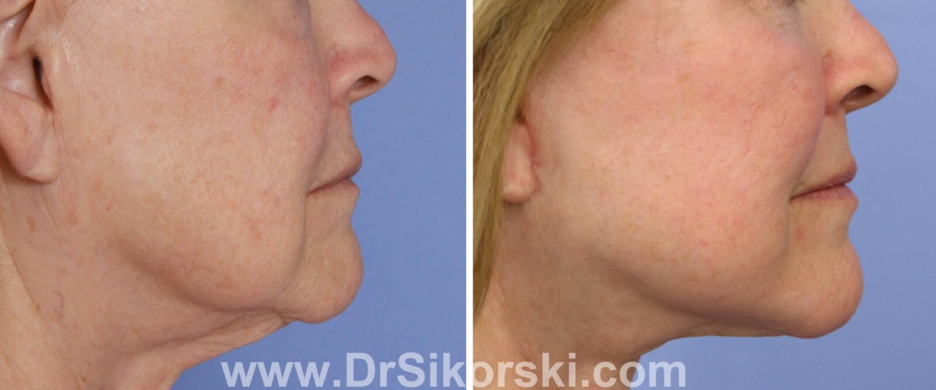 Neck Lifts: A Comprehensive Overview