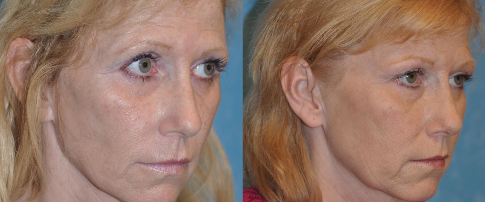 Cheek Lifts: A Comprehensive Overview