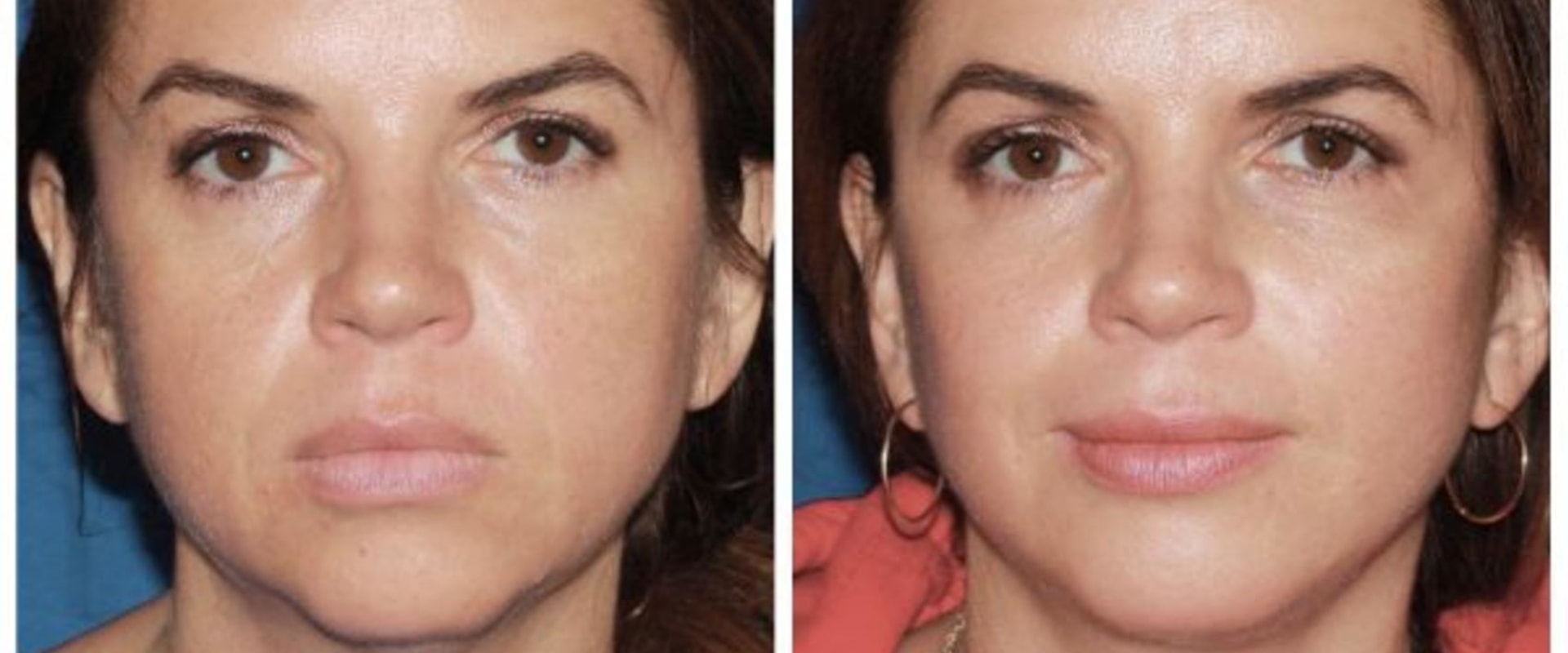 Mini Facelift: A Comprehensive Overview