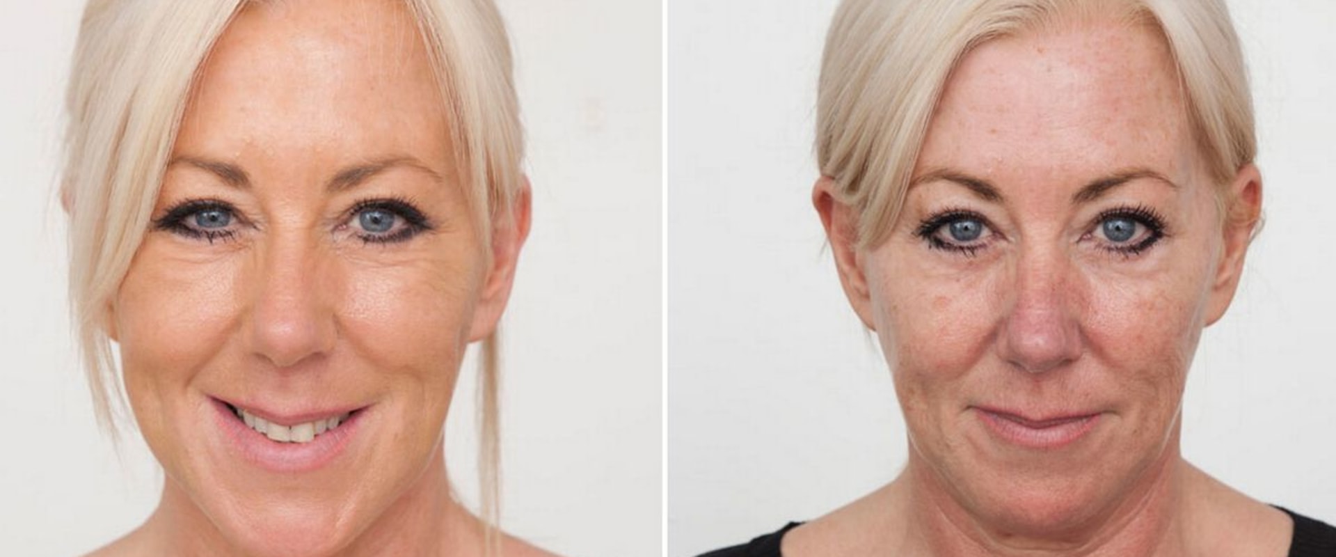 Forehead Lifts: Everything You Need to Know